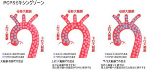 看護師ブログ：ナースねふな仕事と趣味 | 経皮的心肺補助装置：PCPS管理