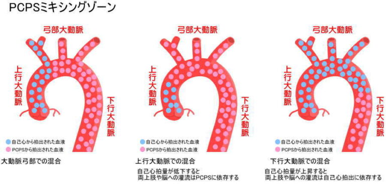 看護師ブログ：ナースねふな仕事と趣味 | 経皮的心肺補助装置：PCPS管理