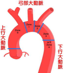 看護師ブログ：ナースねふな仕事と趣味 | 胸部大動脈瘤：Debranch TEVAR